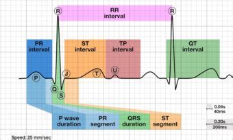 T Wave LITFL ECG Library Basics