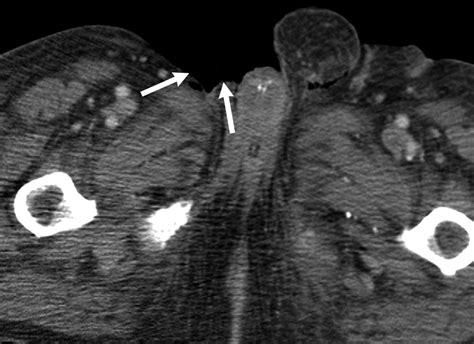 Fournier Gangrene Role Of Imaging Radiographics