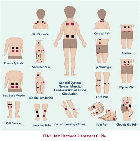 Electrode Placement For Pelvic Floor Stimulation At Christopher Dodd Blog