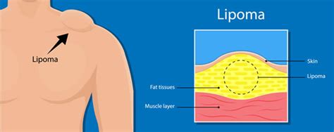 Lipoma Removal Bromley Cyst Removal Bromley Lipoma And Cyst Removal