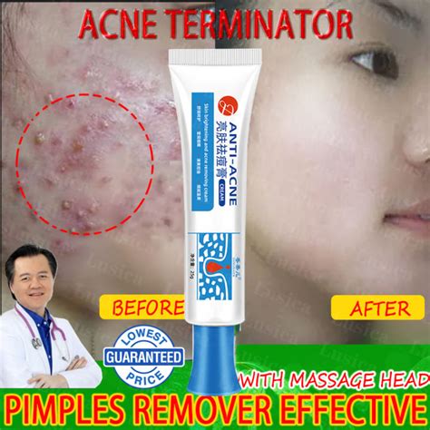 Acne Cream Krim Jerawat Bekas Jerawat Acne Cream 25g Antibacterial Acne Face Cream Acne Gel Spot