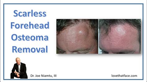Scarless Forehead Osteoma Removal Youtube