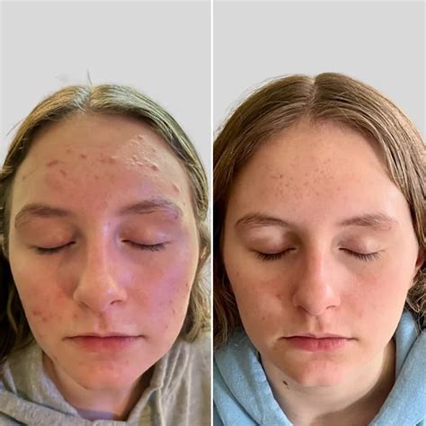 Led Light Therapy For Skin Activeskin