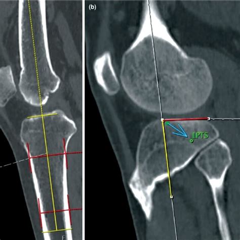 A Proximal Tibial Longitudinal Axis In True Sagittal Plane Yellow