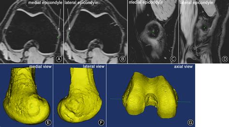 Comparison Of The Femoral Condylar Ellipse Line And The Surgical