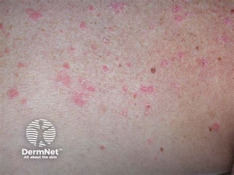 Guttate Psoriasis Images