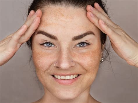 Хиперпигментации I част Мелазма Дерматологична клиника Твойта кожа