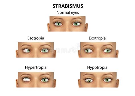 Strabismus Eyes Deviation Illustration Stock Illustration