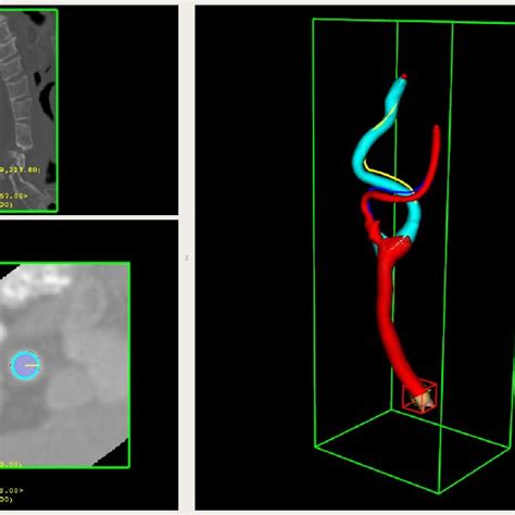 example of the segmentation of a cta image of a carotid using our