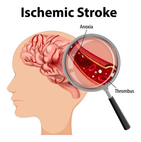 Human Hemorrhagic Stroke Illustration Stock Vector By ©blueringmedia