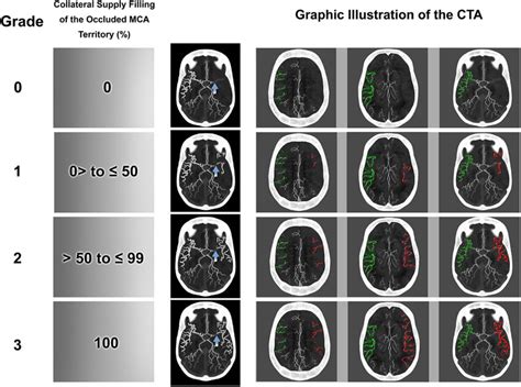 Illustrative Examples Of Collateral Flow Visualized Using Computed Download Scientific Diagram