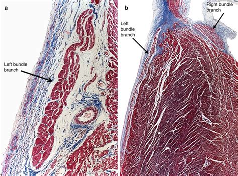 Pathology Of The Cardiac Conduction System Thoracic Key