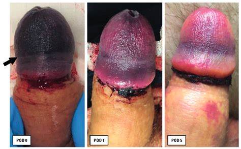 Glans Ischemia After Circumcision