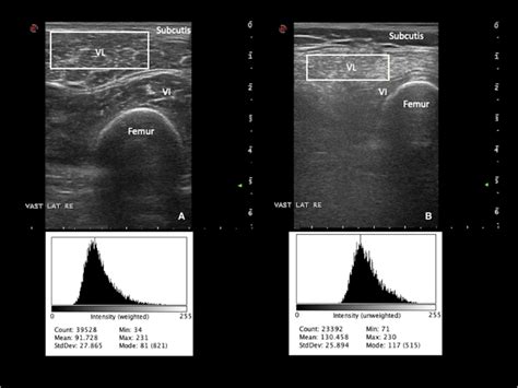 Quantitative Grayscale Analysis In A Healthy A And Diseased Muscle