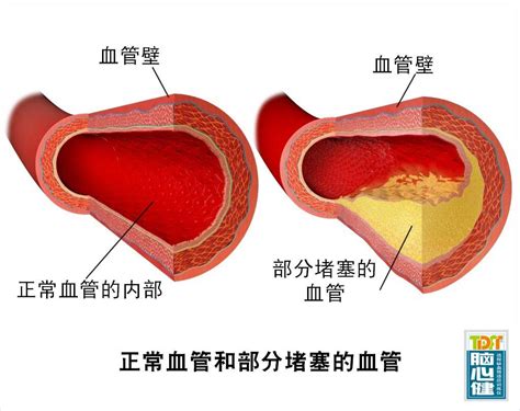 评估动脉硬化程度的无创指标——脉搏波传导速度（pwv） 凤凰网