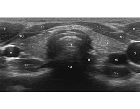 Thyroid Ultrasound Image Labeling Game — Printable Worksheet