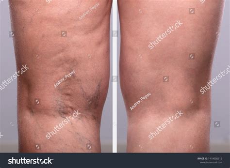 Person Knees Varicose Veins Capillaries Before Stock Photo 1419695912 Shutterstock