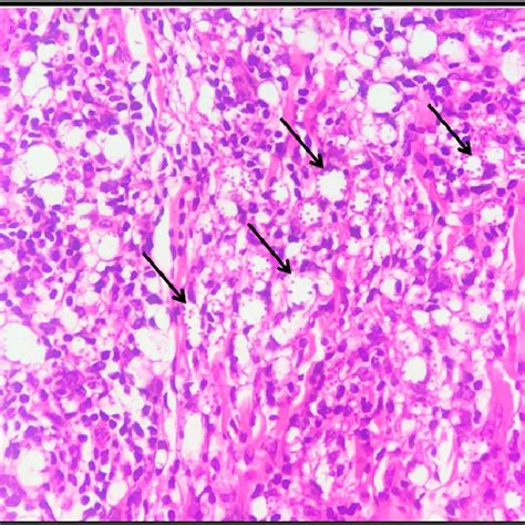 Patient With Diffuse Cutaneous Leishmaniasis Ulcerated Lesion In The Download Scientific