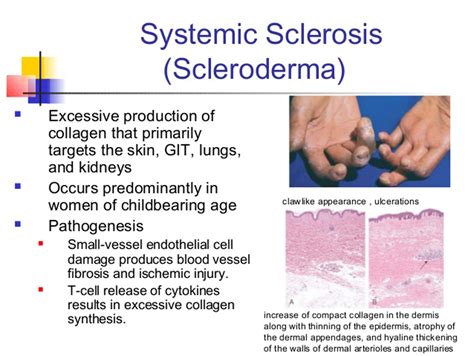 systemic scleroderma hands