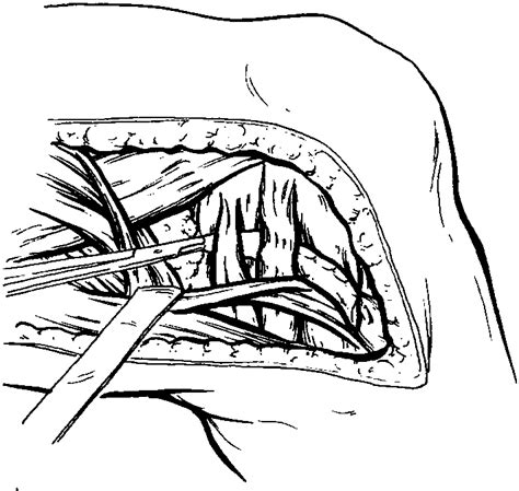 3 陈旧性前交叉韧带损伤重建术 外科学 医学