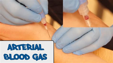 Arterial Blood Gases Procedure Arterial Blood Gas Sampling Abg Osce