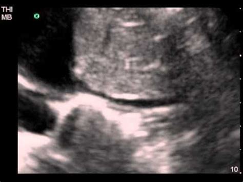 IVC Collapsing Reference 1 YouTube