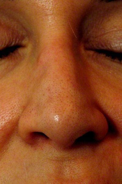 Bony Bump On Nose After Rhinoplasty Bumps After Successful My Xxx Hot Girl