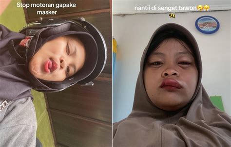Viral Perempuan Ini Curhat Penyesalan Gak Pake Masker Saat Naik Motor Bibirnya Disengat Tawon