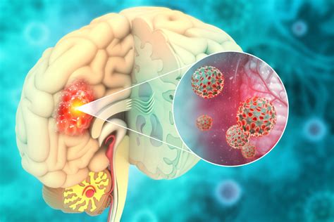Brain Cancer Greater Waterbury Imaging Center