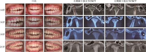 Juvenile Idiopathic Condylar Resorption May Fundamentally Represent