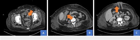 Figure 3 From A Case Report Of Necrotizing Neutrophilic Dermatosis A