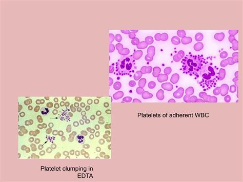 Pseudothrombocytopeniapptx