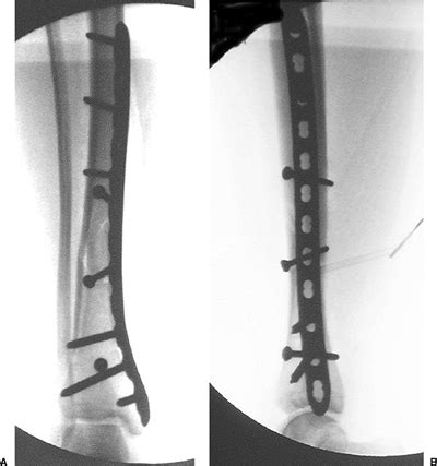 Tibial Shaft Fractures Open Reduction Internal Fixation TeachMe Orthopedics