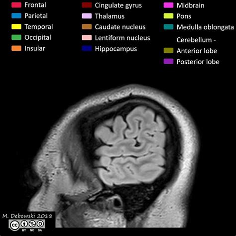 Brain Lobes Annotated Mri Radiopaedia Sagittal Nc Commons