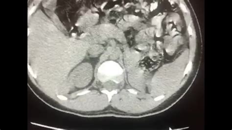 Saeed Bin Hamri On Linkedin Mis Extrophy Ileocystoplasty