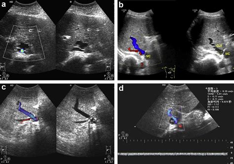 Ultrasonographic Visualization Of Accessory Hepatic Veins And Their