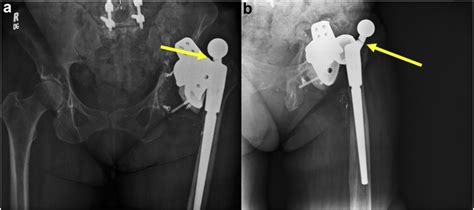 Severe Femoral Component Notching Visible On Anteroposterior View