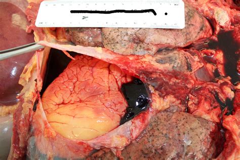 Hemopericardium Due To Free Ventricular Wall Rupture 3rd Eye