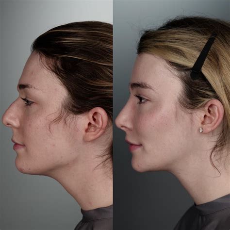 One Month Post Op Ppt Vaginoplasty With Doctor Gabriel Del Corral In