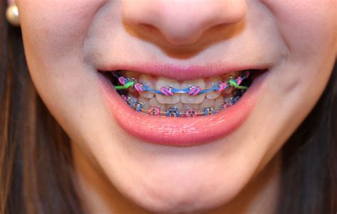 Sawgrass Ortho Customizing Your Braces Cool And Colorful