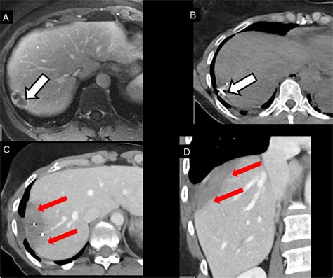 52 Yo Female With History Of Ovarian Carcinoma And Serosal