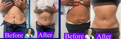 Excess Skin Removal Procedure Panniculectomy In Brooklyn Ny With Insurance And Self Pay