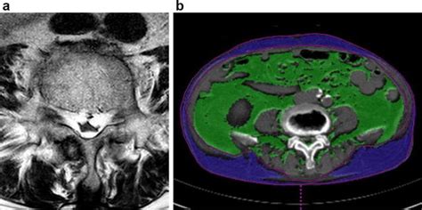 A Mri Showing Compression Of The Dural Sac Caused By Increased Epidural