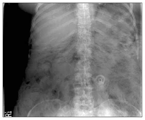 Necrotizing Fasciitis X Ray