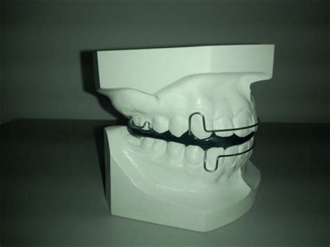 Activator Orthodontic Appliance