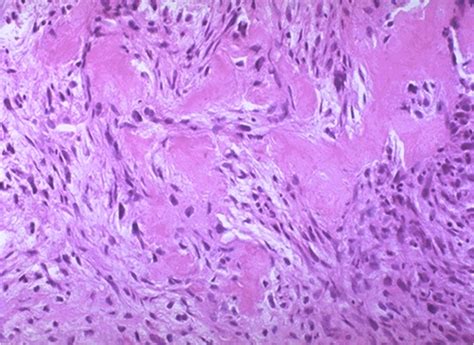 Bone Neoplasms And Benign Bone Tumors Flashcards Quizlet
