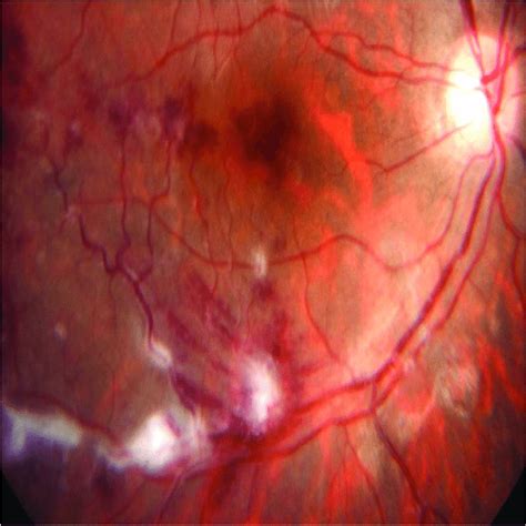Color Fundus Photograph Shows Retinal Periphelbitis Along With