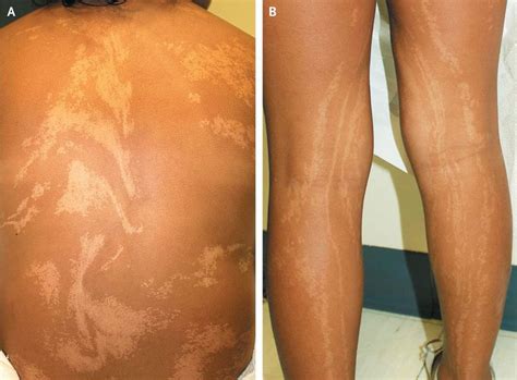 X Chromosomal Translocation And Segmental Hypopigmentation Medizzy