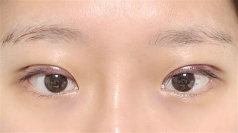 쌍커풀 수술 후기 1 부분절개 통증 쌍수 당일 일주일차 붓기 멍 관리 녹는실 실밥 제거 네이버 블로그