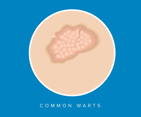 Different Types Of Warts